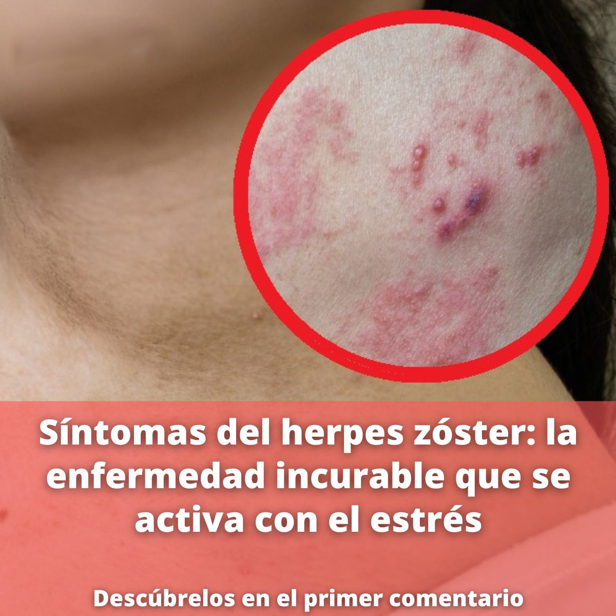 Primeros síntomas del Herpes Zóster y su relación con el estrés - Salud ...
